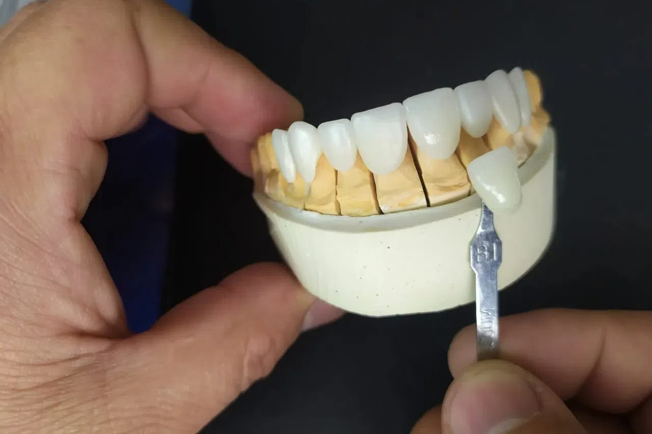 Discover the Versatility of Monolithic Zirconia Crowns in Restorative ...