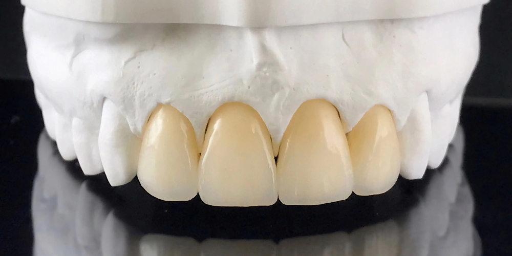 How to Maintain Your Zirconia Tooth Caps for Long-Term Success and ...