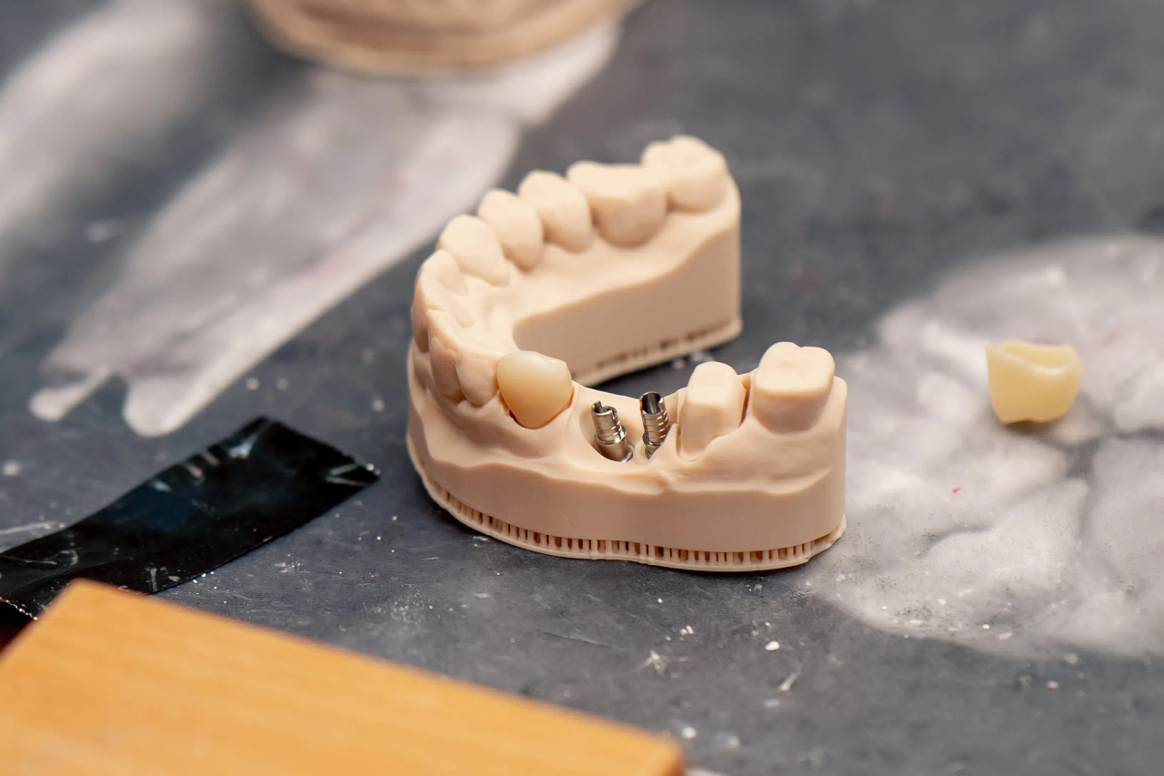 The Aesthetic and Practical Advantages of Monolithic Zirconia Crowns in ...